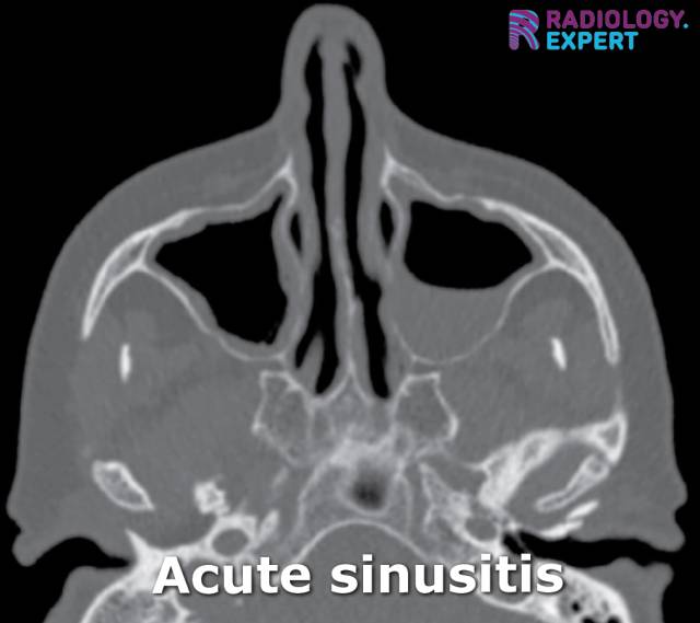 CT sinus